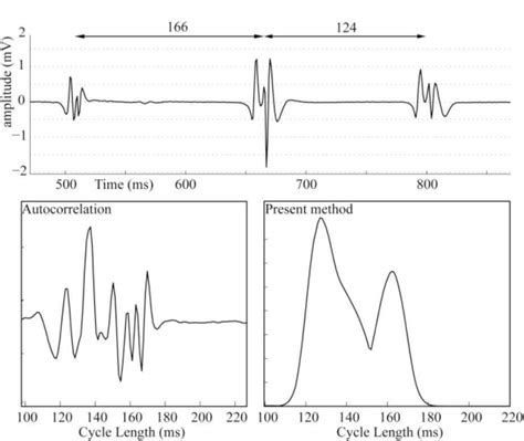 figure 5 from a wavelet transform for atrial fibrillation cycle length