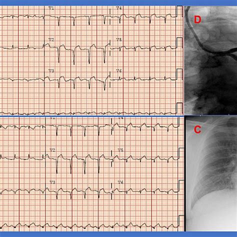 A Diffuse St Segment Elevation B Ekg One Hour Later Showed No