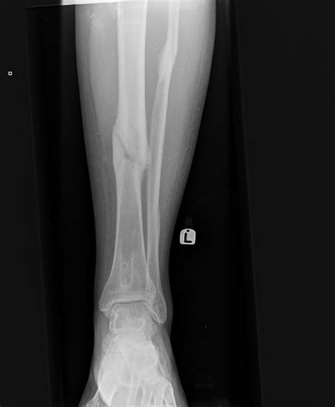 Hijacking And Broken Tibia And Fibula Rxrays