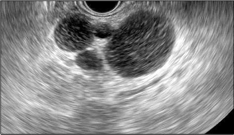 Eus Findings Eus Revealed Three Enlarged Lymph Nodes Measuring 17 Cm