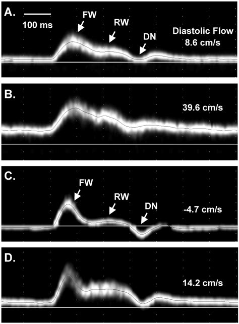 Local Shear Stress And Brachial Artery Flow Mediated Dilation