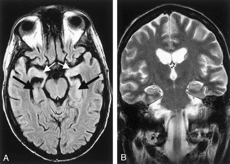 Acute Limbic Encephalitis A 26 Year Old Man With Underlying Precursor