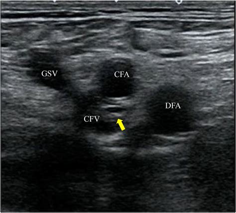 Ultrasound Guided Stenting In The Common Femoral Vein For Accurate