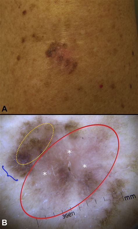 The Role Of TERT Promoter Mutations In Differentiating Recurrent Nevi