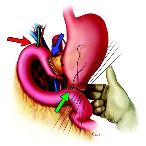 Ct After Pancreaticoduodenectomy Spectrum Of Normal Findings And