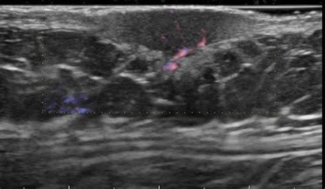 Breast And Axilla 5 2 Malignant Breast Lesions Case 5 2 12 Lymph Node Metastases And Local