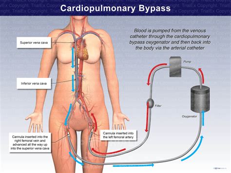 Cardiopulmonary Bypass Diagram