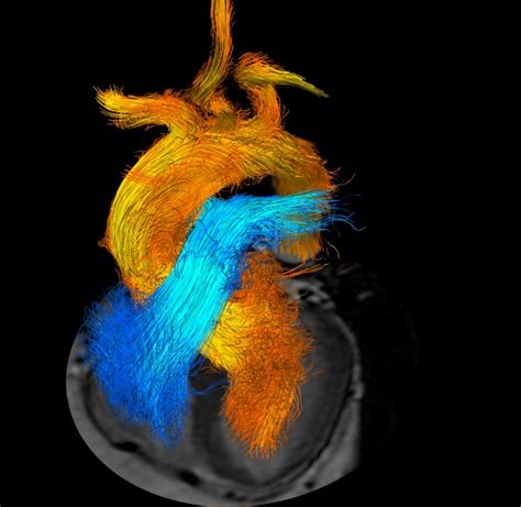 Video Computational Fluid Dynamics For Surgical Planning Inside Hpc
