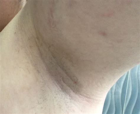 Swollen Sweat Glands In Armpit