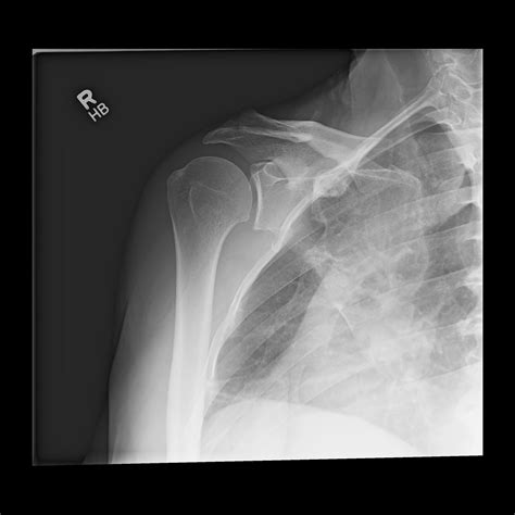 Orthodx Glenoid Fracture Clinical Advisor