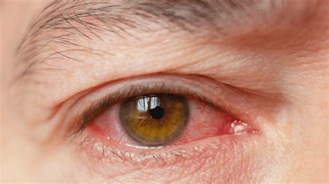 What Is Uveitis Symptoms And Treatment Oasiseye Specialists