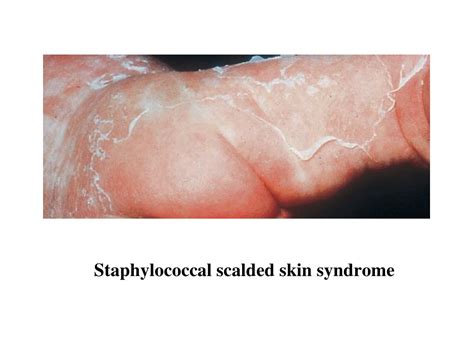 Ppt Blistering Diseases Powerpoint Presentation Free Download Id