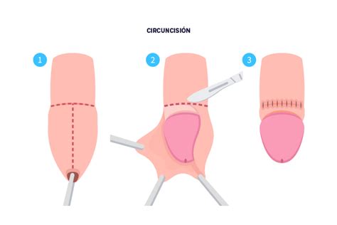 Circuncisión Dr Luis Wadskier Urológo