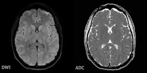 Diffusion Weighted Imaging Of Normal Brain Mri Dwi And Adc Map Fotografias De Stock E Mais