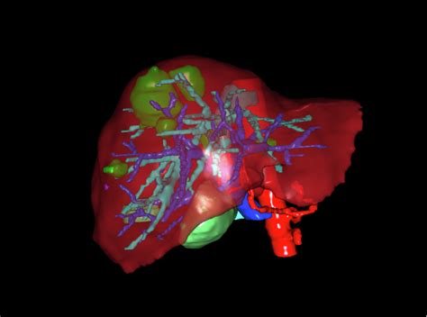 3d Reconstruction Patient Specific 3d Model Of The Liver Generated By