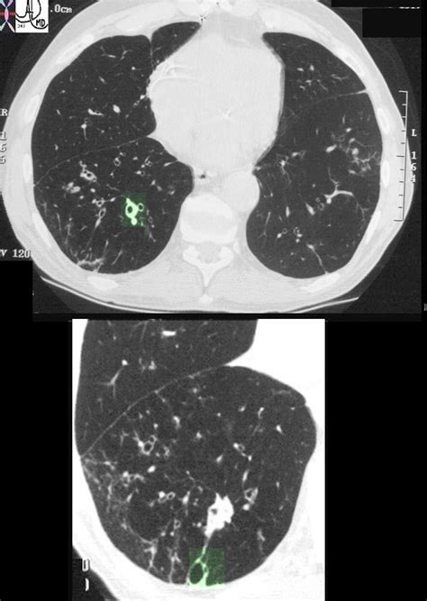 Faces Of Bronchial Wall Thickening Lungs