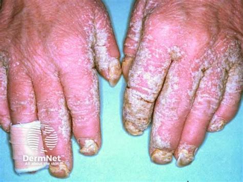 Crusted Scabies