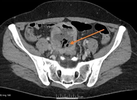 Ct Axial Image With Arrow Showing The Midline Lower Abdominal Pelvic Download Scientific
