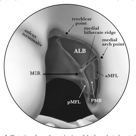 Sulcus Terminalis Femur