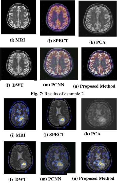 Figure 1 From Multimodality Medical Image Fusion Based On Hybrid Fusion Techniques Semantic