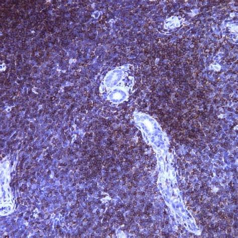 Nodular Infiltrate Of Lymphoma With A Marginal Zone Pattern Of Growth