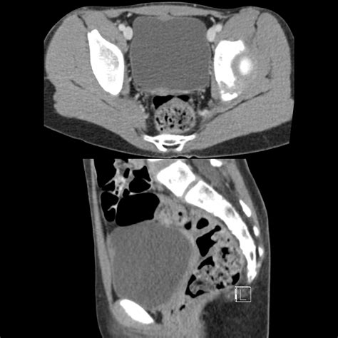 School Ager With Periumbilical Pain Pediatric Radiology Case