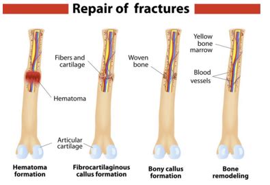 Explain The Difference Between A Fracture And A Broken Bone Case Has Shannon
