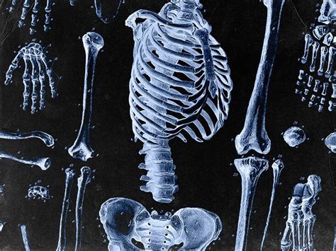 Diseases That Cause Poor Bone Development Common Bone Diseases