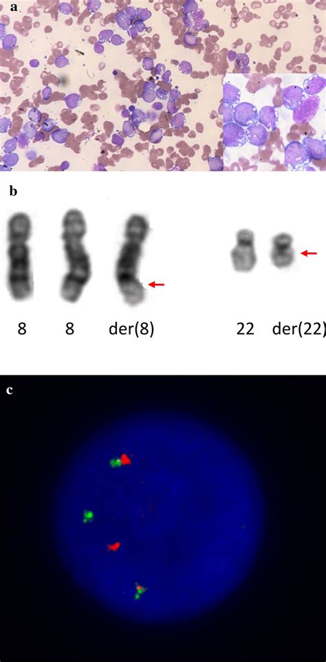 B All A Bone Marrow Infiltration By Blasts With L3 Morphology ×20 Download Scientific Diagram