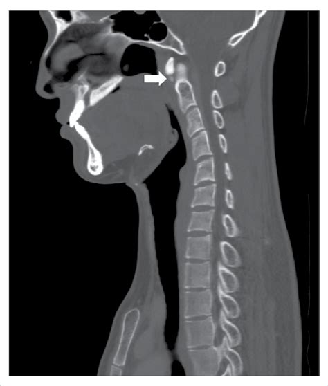 Sagittal View Computed Tomography Image Of The Neck Demonstrating
