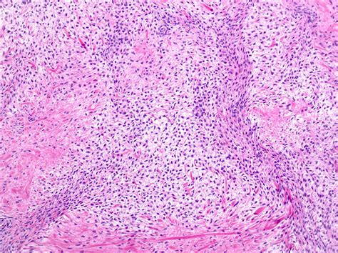 Pathology Outlines Fibroma