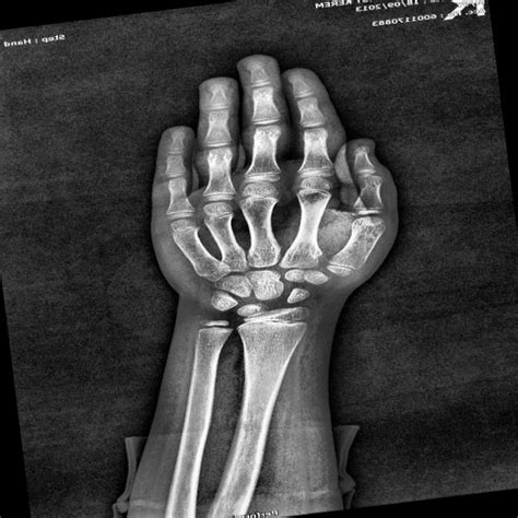 bone fracture detection object detection dataset v8 2024 02 06 10