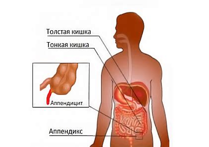 Осложнения после удаления аппендицита: последствия
