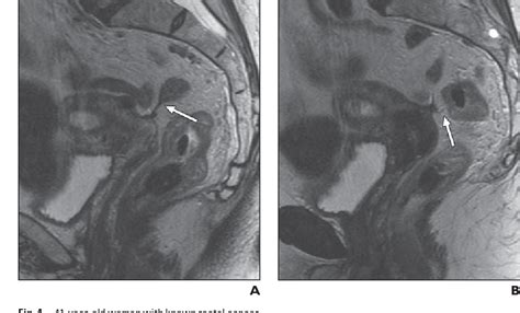 Peritoneal Reflection Sigmoid