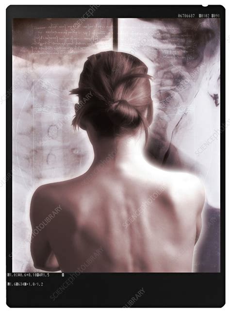 Woman With Neck X Ray Stock Image M415 0512 Science Photo Library