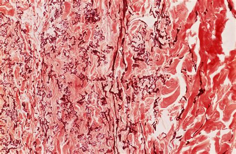 Pseudoxanthoma Elasticum Histology