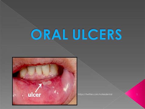 Dental Notes Oral Ulcers NOTES
