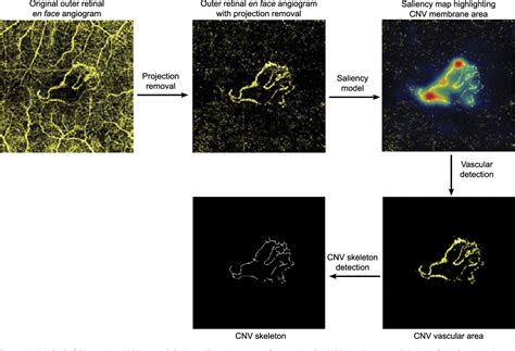 Figure 1 From Classification Of Choroidal Neovascularization Using