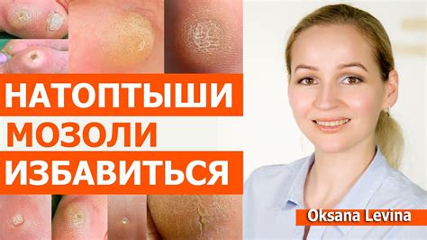 Натоптыши на ступнях: какую мазь для лечения выбрать