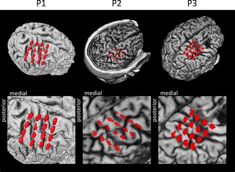 Locations Of The Epidurally Implanted ECoG Electrodes Patients Were Download Scientific