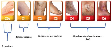 Ceap C Classes Cvi Chronic Venous Insufficiency Download