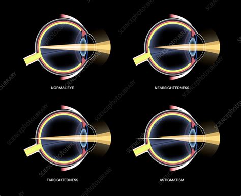 Refractive Errors That Impact Vision Illustration Stock Image F0438068 Science Photo Library