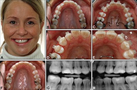 Dental Health Assessed After Interproximal Enamel Reduction Caries Risk In Posterior Teeth