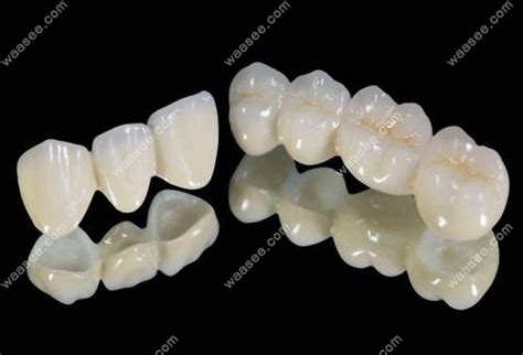 阿曼吉尔巴赫全瓷牙1300还是3千一颗和德国威兰德区别是啥 口腔资讯 牙齿矫正网