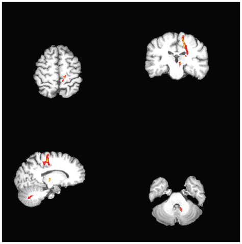 Thalamotomy Plos One