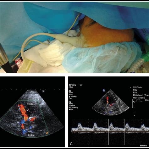 Intraoperative Photos Of Cerebral Perfusion Monitoring Using Download Scientific Diagram