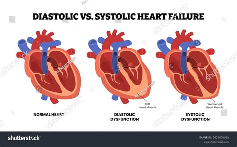 Diastolic Vs Systolic Heart Failure Educational Stock Vector Royalty