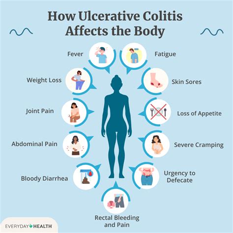 Ulcerative Colitis Symptoms Crohns Disease Causes Symptoms And