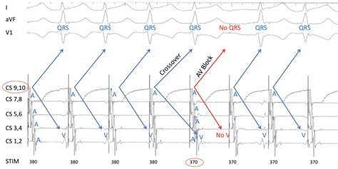 Electrogram Interpretation 12 Ep Essentials
