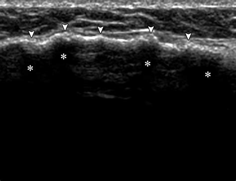 Multimodality Imaging Based Evaluation Of Single Lumen Silicone Breast